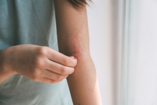 Types d’eczéma : causes, symptômes et traitements efficaces